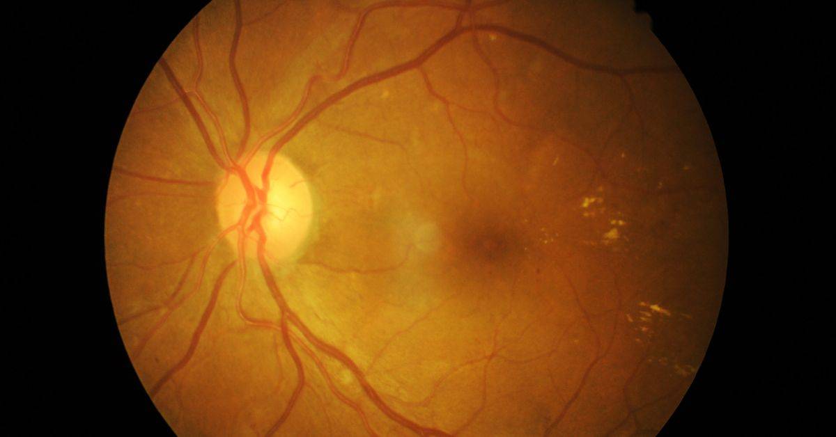 Retinal Damage Be Reversed? | Associated Retina Consultants ...